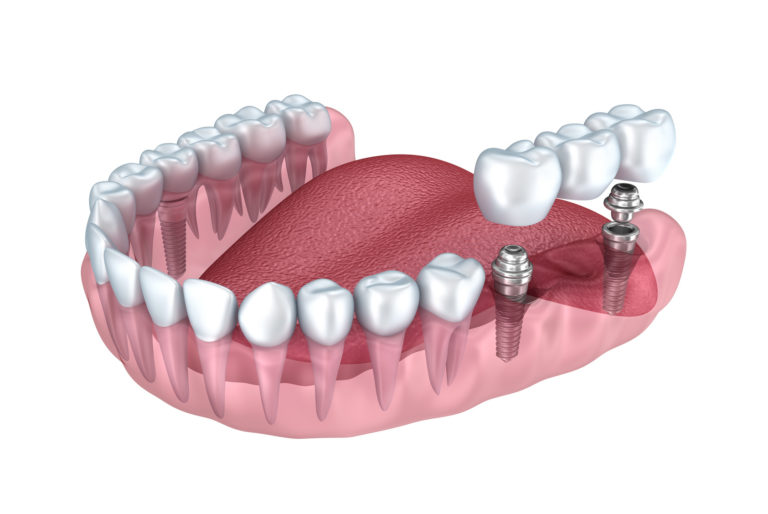 Imagens de Implantes e Próteses Dentárias | OdontoYama
